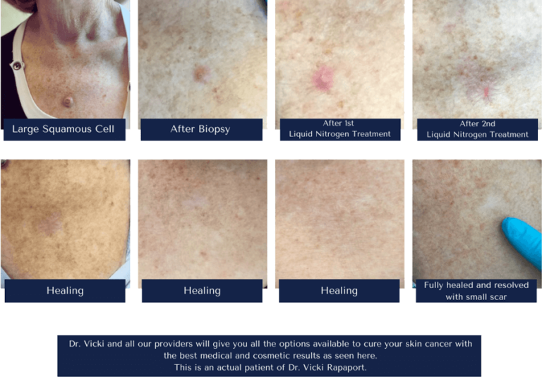 Skin Cancer Specialist - Beverly Hills, CA & Culver City, CA: Rapaport ...